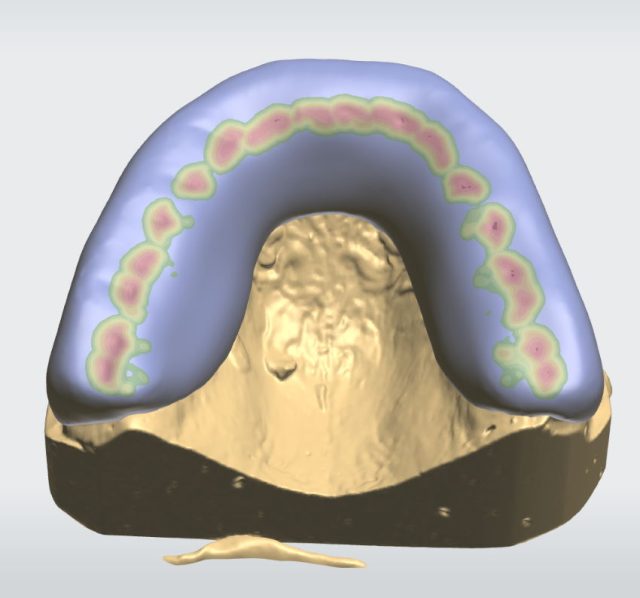 Bite Splint – CAD Design – CAE Dental