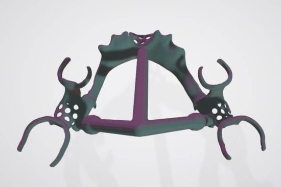 RPD Cast Frame – CAD Design – CAE Dental