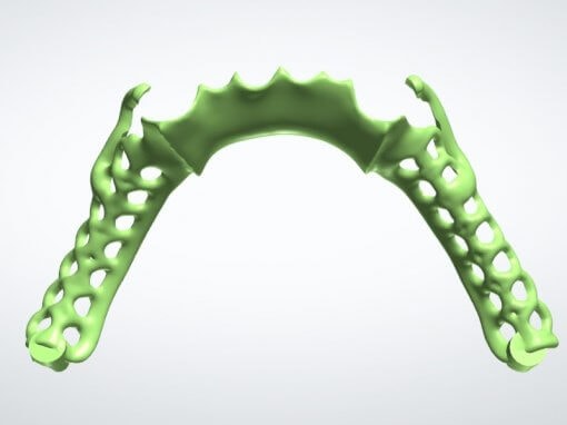 RPD Cast Frame – CAD Design – CAE Dental