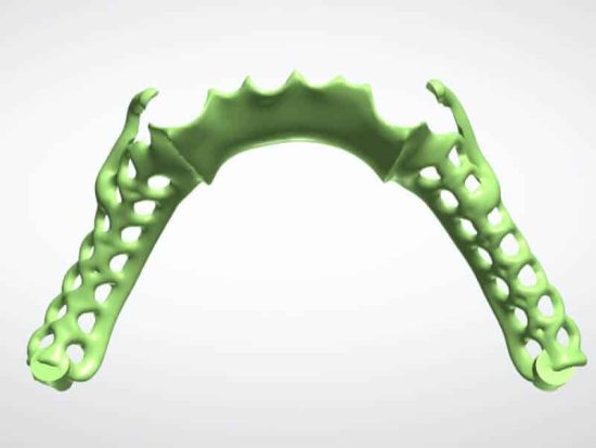 RPD Cast Frame – CAD Design – CAE Dental