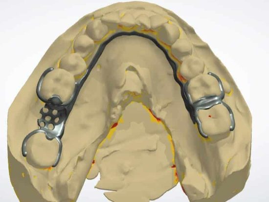 RPD Cast Frame – CAD Design – CAE Dental