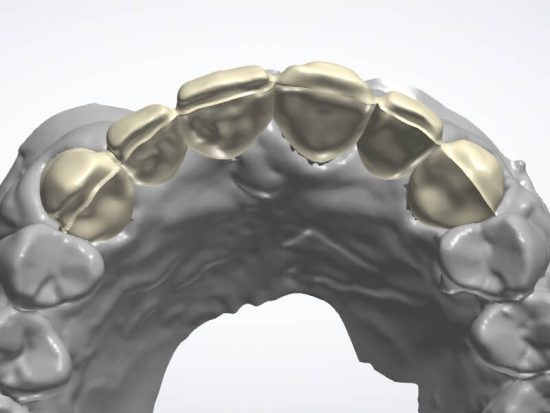 Coping – CAD Design – CAE Dental