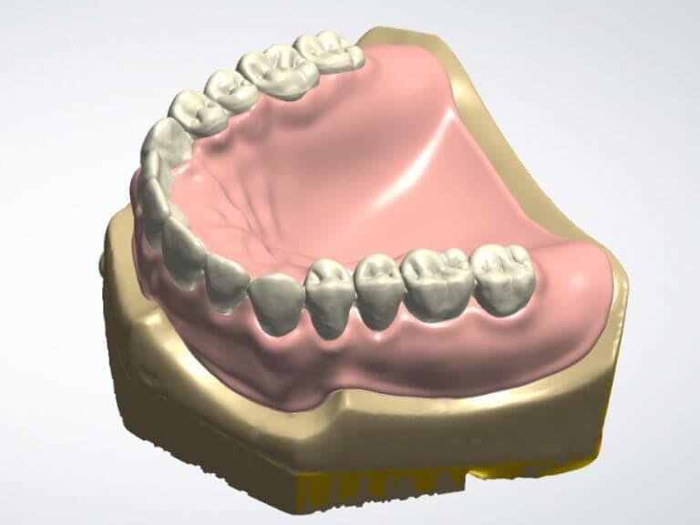 Digital Denture - CAD Design - CAE Dental
