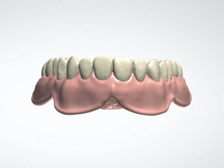 Digital Denture - CAD Design - CAE Dental