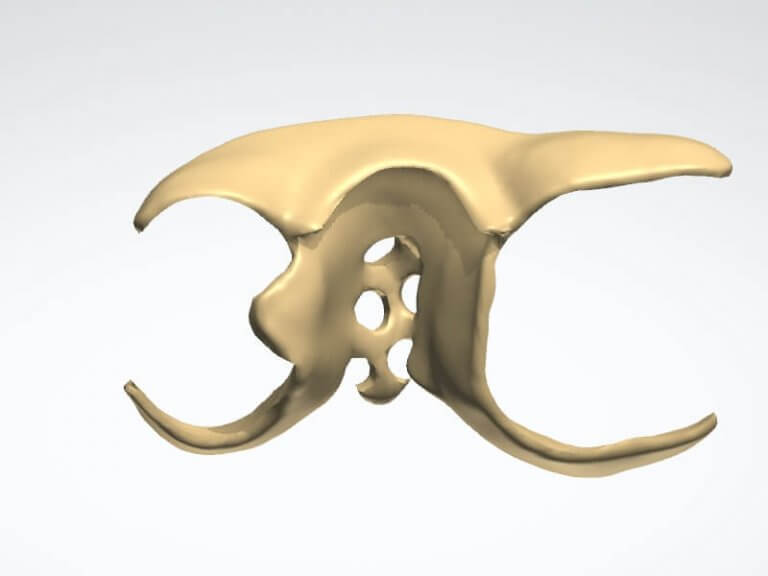 Flexible Partial / Acetal Partial Framework – CAD Design – CAE Dental