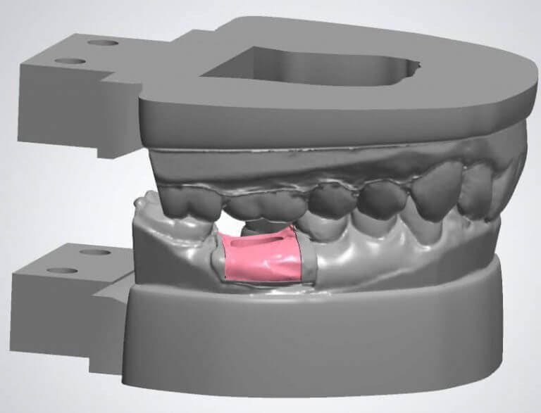 Implant Model – CAD Design – CAE Dental
