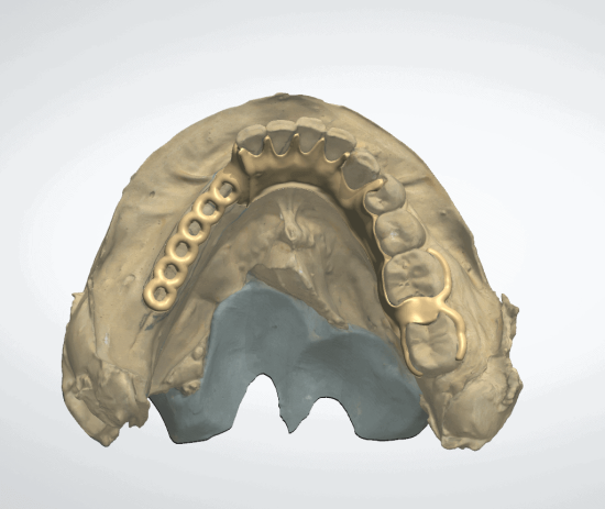 RPD Cast Frame – CAD Design – CAE Dental