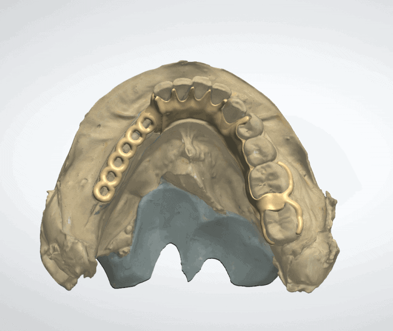 RPD Cast Frame – CAD Design – CAE Dental