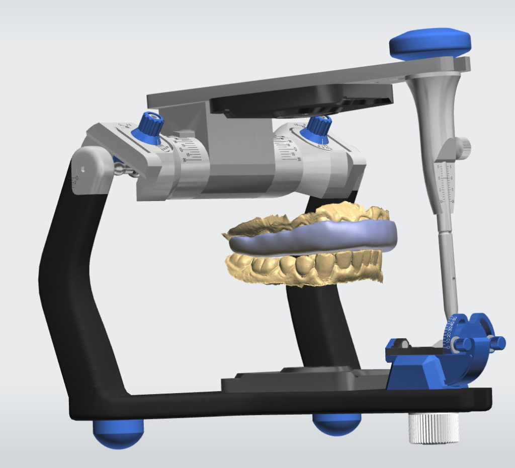 Bite Splint – CAD Design – CAE Dental