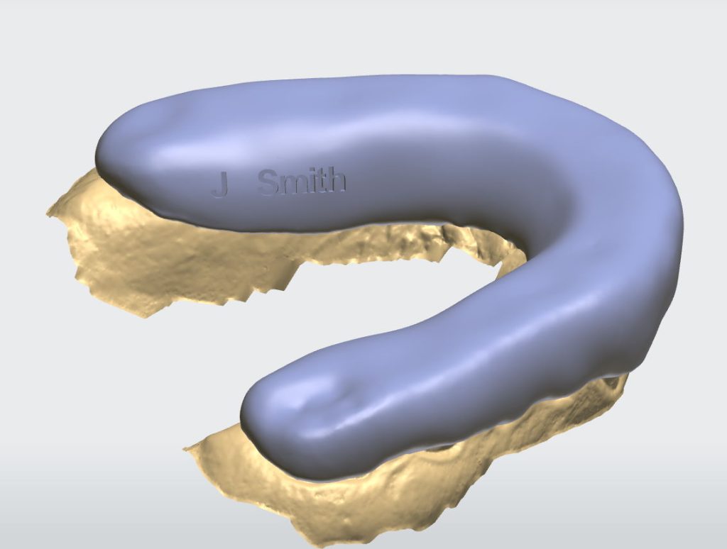 Bite Splint – CAD Design – CAE Dental