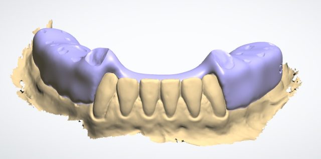 Mora / Gelb Appliance – CAD Design – CAE Dental