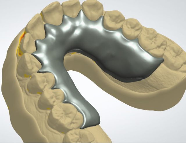 Retainer Base Plate – CAD Design – CAE Dental