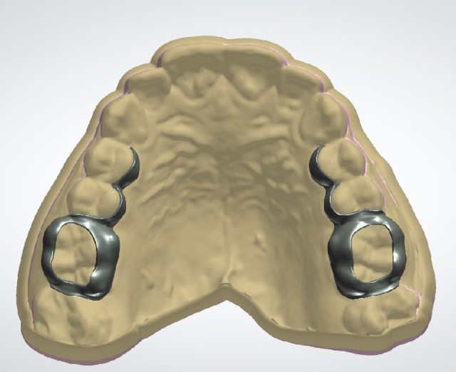 Custom Expander Bands – CAD Design – CAE Dental