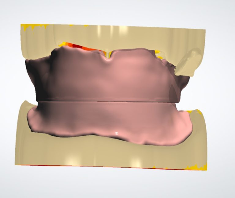 Denture – Partial Wax Rim – CAD Design – CAE Dental
