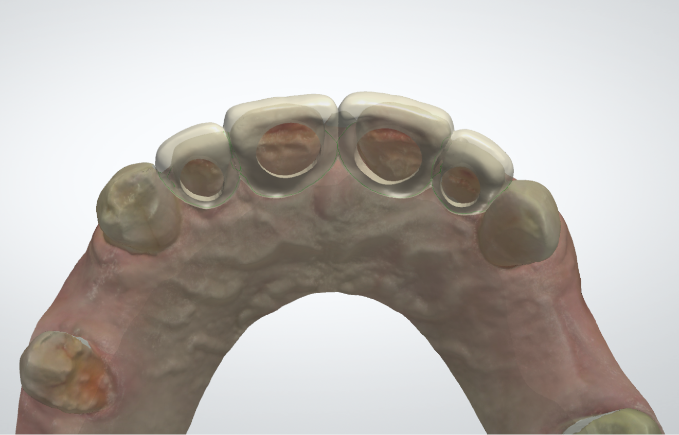 Snap on Smile – CAD Design – CAE Dental