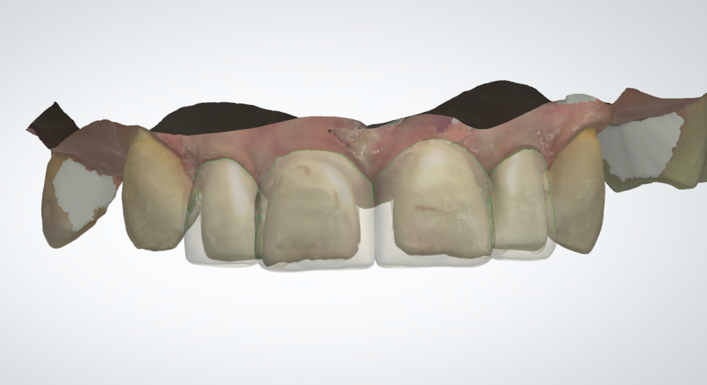 Snap on Smile – CAD Design – CAE Dental