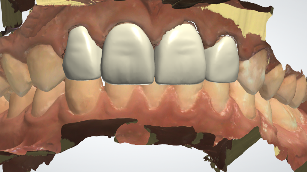 Snap on Smile – CAD Design – CAE Dental