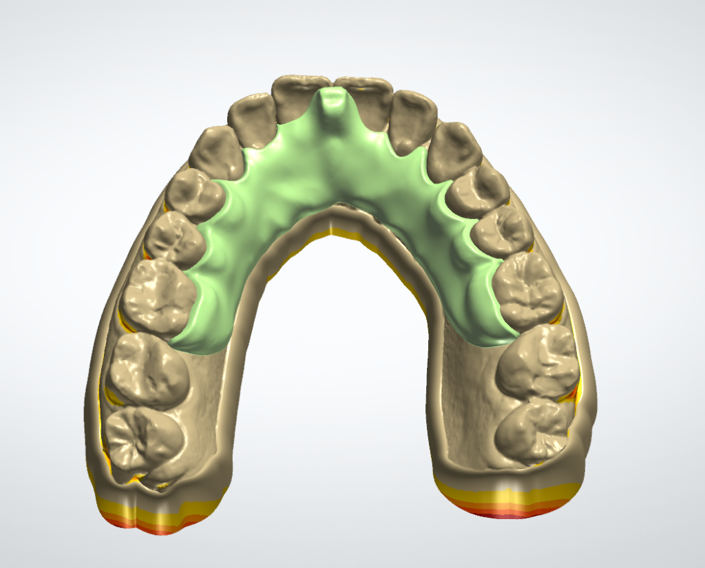 Kois Deprogrammer – CAD Design – CAE Dental